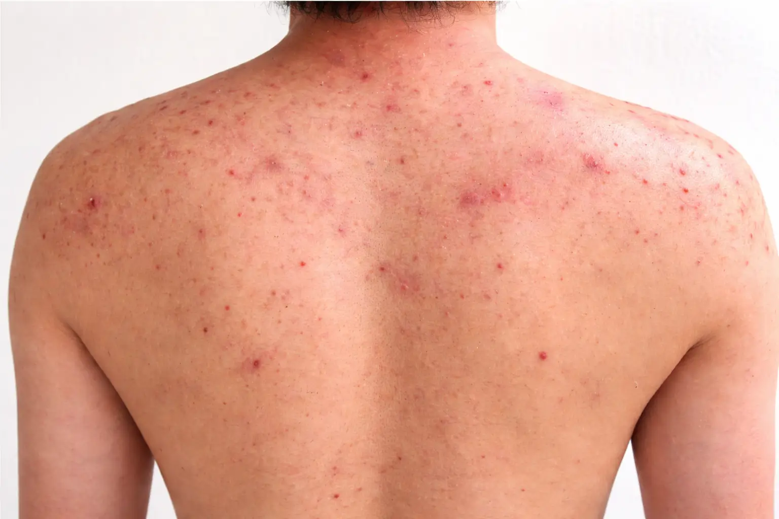 How to Treat Back Acne (Bacne): Causes, Treatments & Prevention